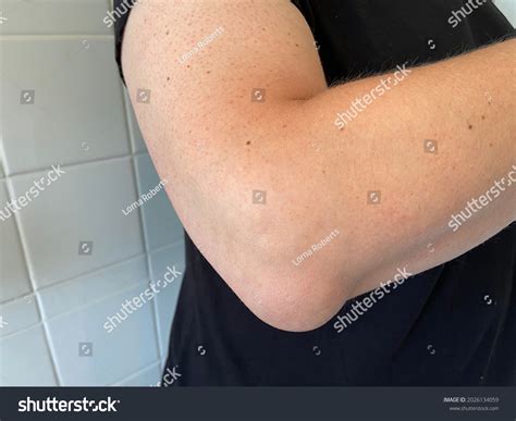 Elbow Bursitis And Bruising At Samuel Sargent Blog
