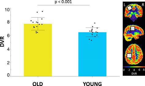 Gamma Aminobutyric Acid Type A Gaba A R Availability For The Left