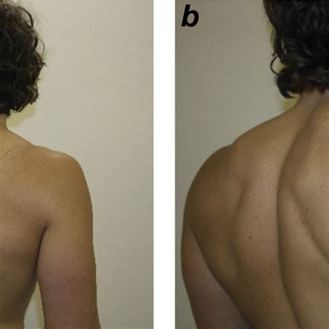 Scapular Correction A Upward Rotation Slight Posterior Tilt During Download Scientific