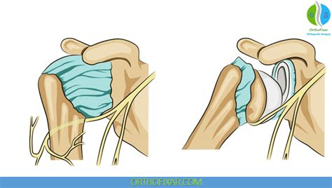 Anterior Shoulder Dislocation Axillary Nerve