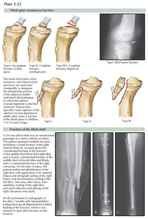 Tibial Intercondylar Eminence Fracture Pediagenosis