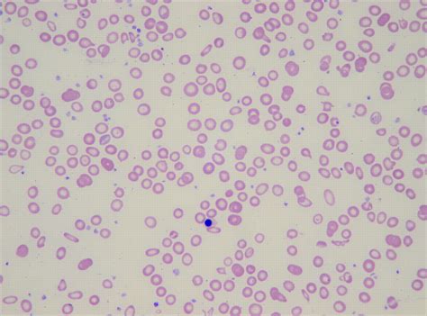 Anaemia In A Year Old Babe The BMJ