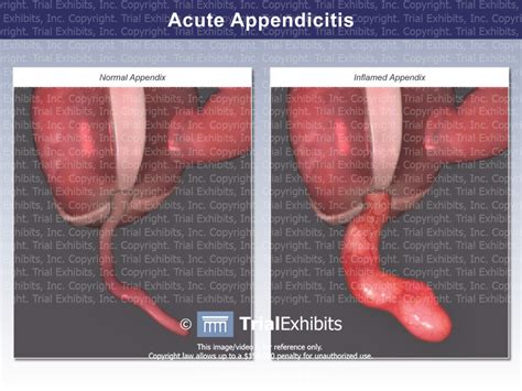 Acute Appendicitis Trialquest Inc
