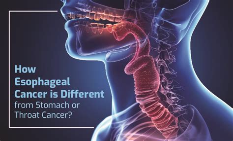 How Esophageal Cancer Is Different From Stomach Or Throat Cancer