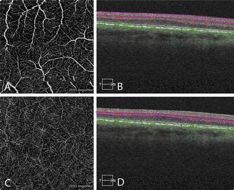 Octa Fields Of View Showing Superficial And Deep Retinal Capillaries