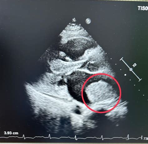 Critical Heart Condition Successfully Treated Under Universal Coverage
