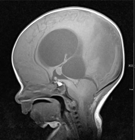 Figure 2 From Segmental Spinal Dysgenesis With Open Spinal Dysraphism