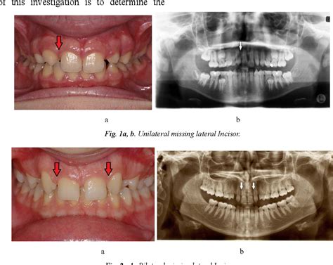 Figure 1 From Prevalence Of Missing Lateral Incisor Agenesis In An Orthodontic Arabs Population