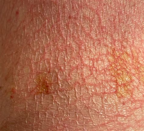 Lacy Rash Rdermatologyquestions Lacy Rash Rdermatologyquestions