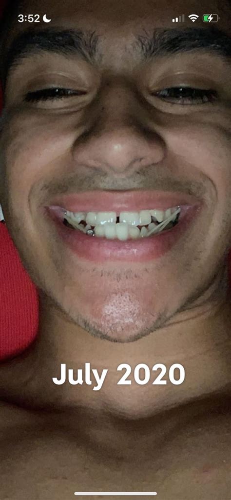 Underbite Before And After R Braces