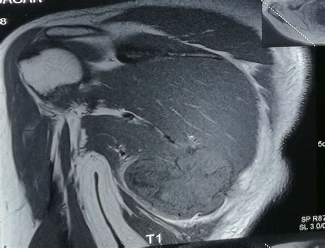 Giant Cell Tumour Of The Scapula Treated By Partial Scapulectomy Bmj Case Reports