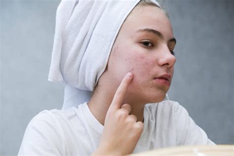 Treating Cystic Acne What To Do And What Not To Do