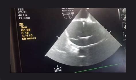 Islam Mohammad Shehata On Linkedin Dissection Tee Cardiac Arrest