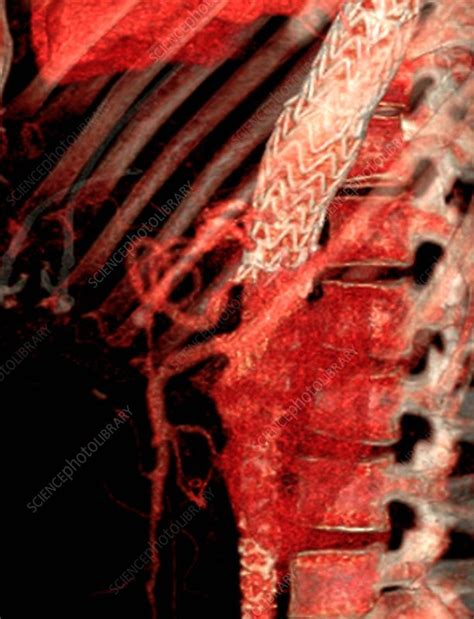 Stent In Aortic Dissection 3d Ct Angiogram Stock Image C0371725