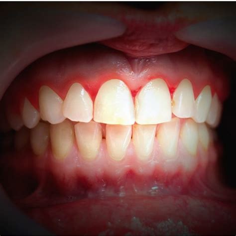 Gingivita • Gingia Afecțiune Ce Reprezintă începutul Bolii Parodontale