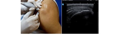Musculoskeletal Ultrasound Guided Steroid Injection By The Subacromial Download Scientific