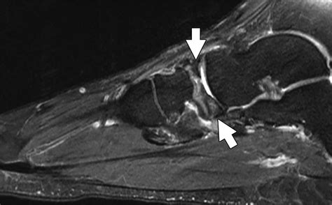 Imaging Of Mueller Weiss Syndrome A Review Of Clinical Presentations