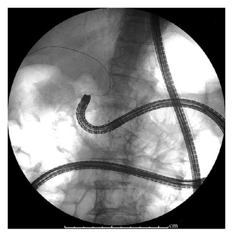 Enteroscope Assisted Ercp A X Ray Film Showed That An Enteroscope Download Scientific