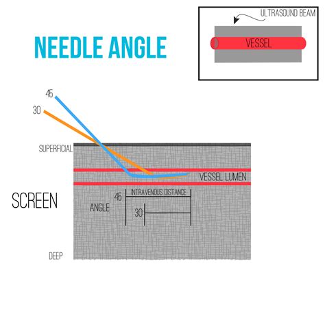 Intravenous Angle