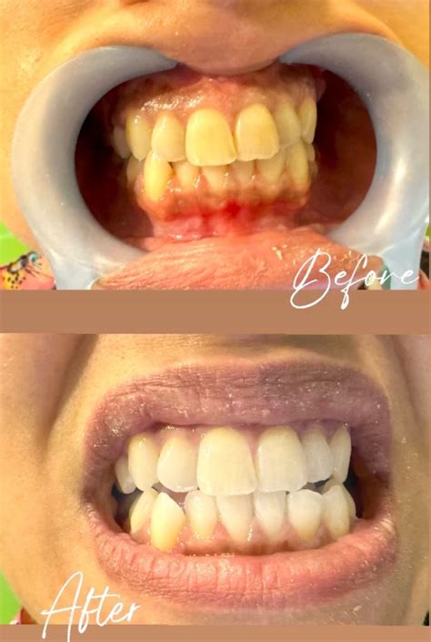 Teeth Whitening Is A Popular Cosmetic Procedure Designed To Lighten The Color Of Your Teeth And