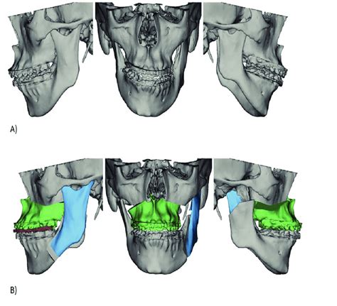 A Pre Operative 3d Reconstruction From The Ct Scan Data Demonstrating Download Scientific