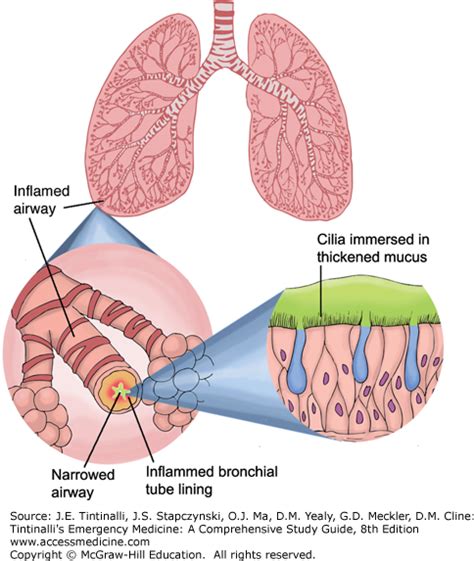 Acute Bronchitis And Upper Respiratory Tract Infections Anesthesia Key