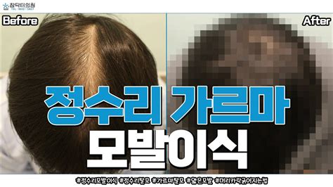 가르마 탈모 얇은 모발도 볼륨감 풍성함 모두 잡을 수 있어요~ Youtube