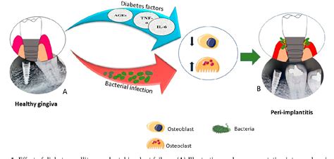 Figure 1 From Carbon Nanomaterials Modified Biomimetic Dental Implants For Diabetic Patients