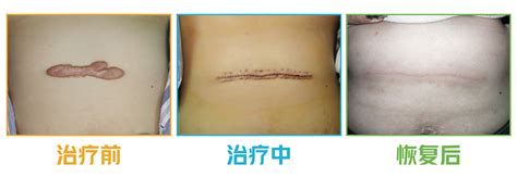 让瘢痕隐形的新晋 黑科技”——超减张美容缝合技术 知乎