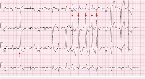 NSVT And PVCs With Right Bundle Branch Morphology And Inferior Axis Download Scientific Diagram
