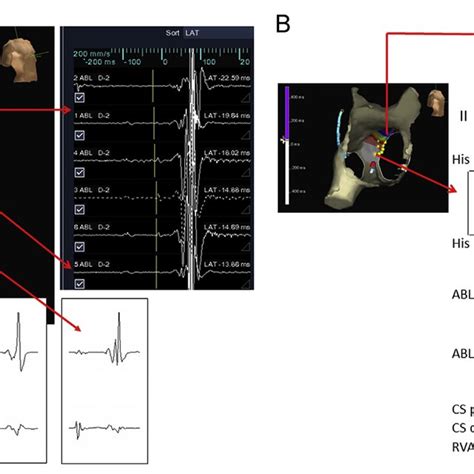 Slow Pathway And Fast Pathway Ablation On Conduction Curve And Zhangs