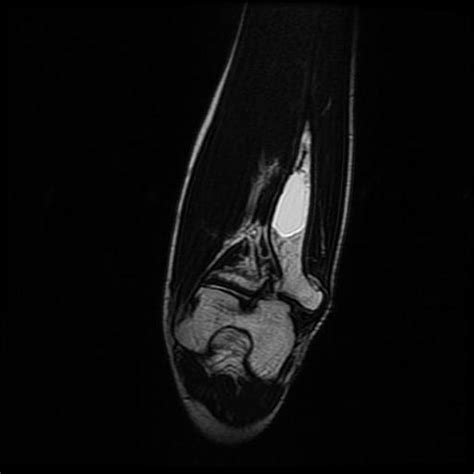 Pseudoarthrosis Pacs