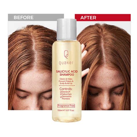 Qquaker Best 3 Salicylic Acid Scalp Treatment Shampoo Controls Flaking