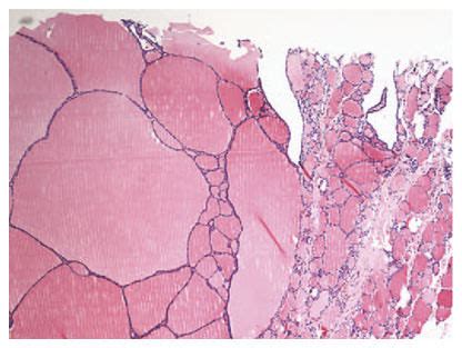 Hyperplastic Thyroid Tissue Note The Thyroid Follicles With A Smooth Download Scientific