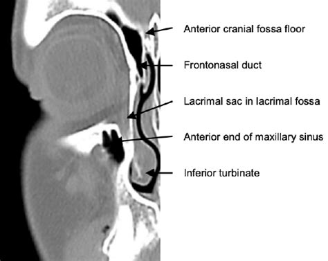 4 3 External Ethmoidectomy And Frontal Sinusotomy Trephine Medicine