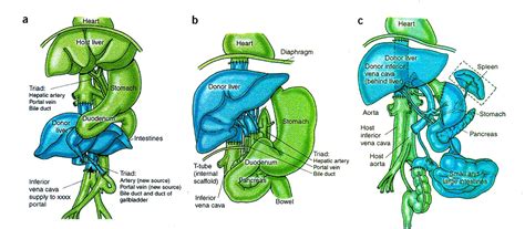 Auxiliary Liver Transplant In Delhi India Auxiliary Liver Transplantation In India
