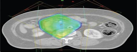 Role Of Neoadjuvant Concurrent Chemoradiation In Locally Adv Indian Journal Of Cancer