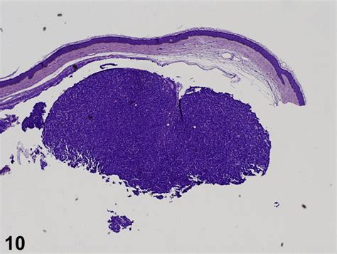 Vermiculate Atrophoderma Aktuelles Management Des Basalzellkarzinoms