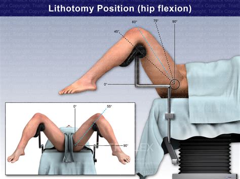 Lithotomy Position Hip Flexion
