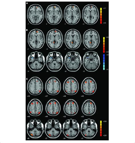 Cerebellar Connectivity Differences Between Patients With And Without Download Scientific