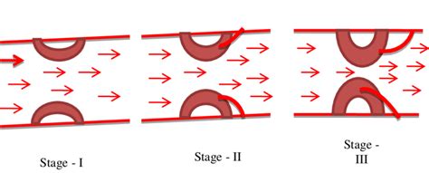 Three Stage Of Stenosis Growth Download Scientific Diagram