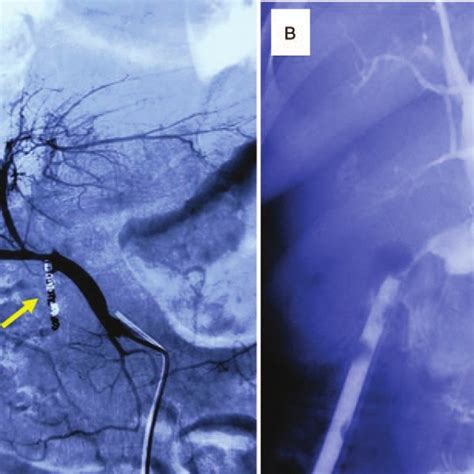 Images When Obstructive Cholangitis Happened A Mrcp Showed Dilation