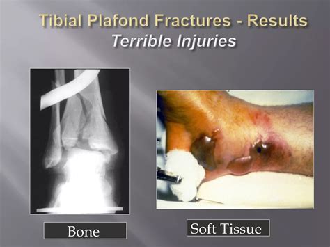 Lecture Ucmc Pilon Plafond Fracture Distal Tibia Ppt Death Injury