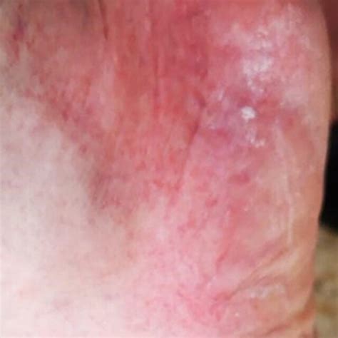 Procedure In The Case Of Clinical Suspicion Of Immediate Download Scientific Diagram