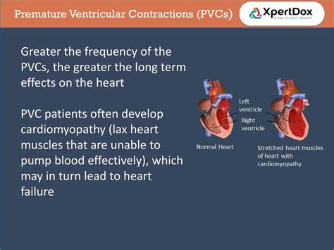 Ppt Premature Ventricular Contraction Powerpoint Presentation Free