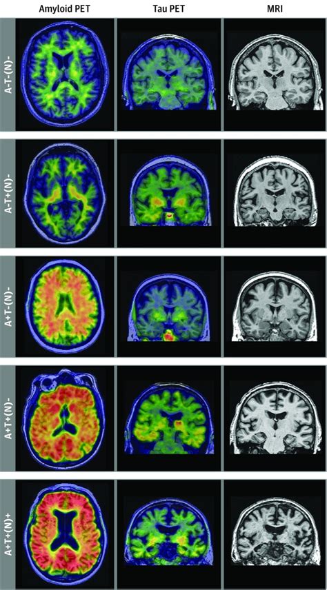Associations Of Amyloid Tau And Neurodegeneration Biomarker Profiles