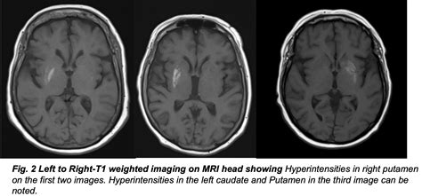 A Case Series Of Hemichorea Hemiballism Associated With Non Ketotic
