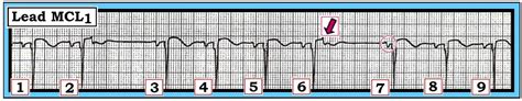 Ecg Interpretation Ecg Interpretation Review 14 Pause Av Block Vs