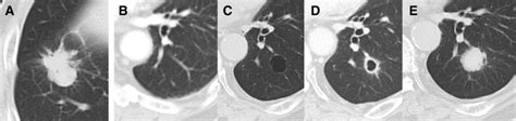 Chest Computed Tomography Ct Findings A An Irregular Nodular
