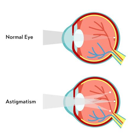 What Is Astigmatism